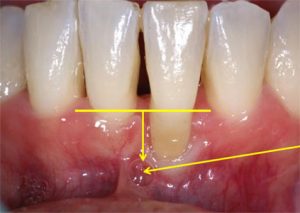 Laser Frenectomy Procedure, Tongue-Ties and Lip-Ties - Seattle Smiles ...